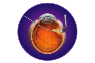 Purepoint® Laser System and Vektor™ Laser Probe | Alcon Global